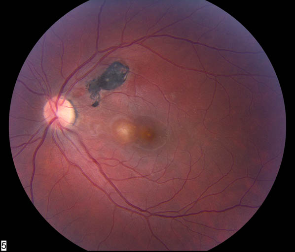 Best Ocular Histoplasmosis Syndrome Treatment | Top Hospitals & Medical ...